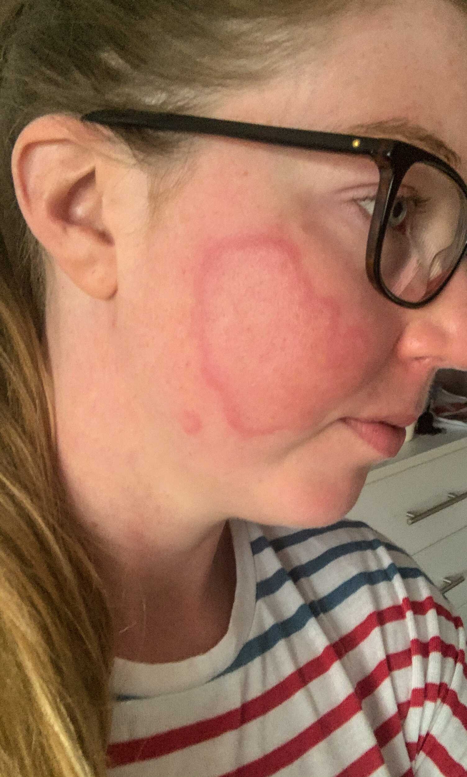 Sinuses, Fatigue, And Rashes - Living With The Wolf